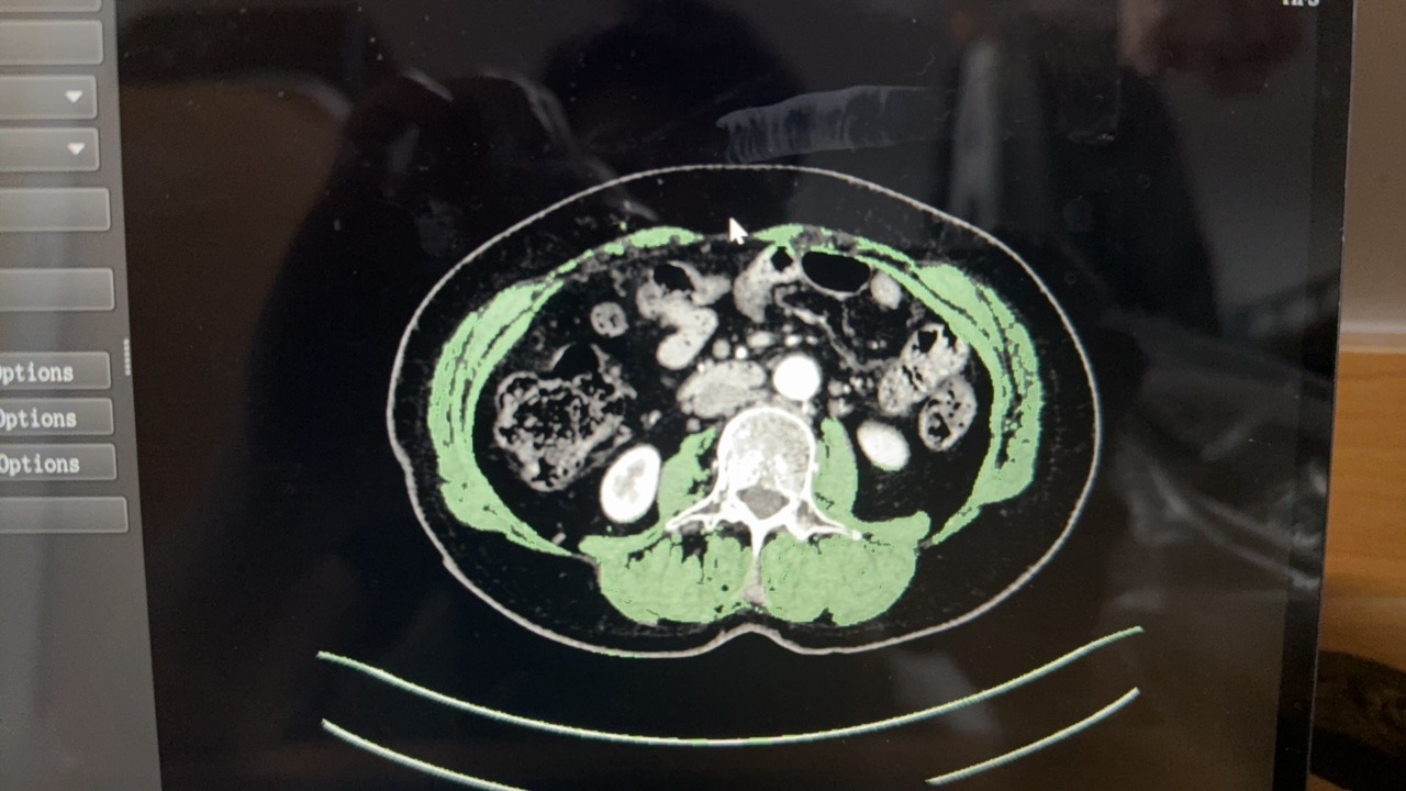 3DSlicer 怎么测单层 CT 横截面的骨骼肌面积，研究半天了_学习和成长-CSDN问答