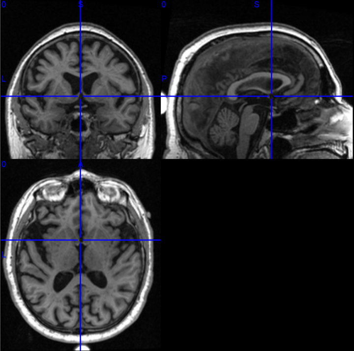 sMRI预处理-CSDN博客