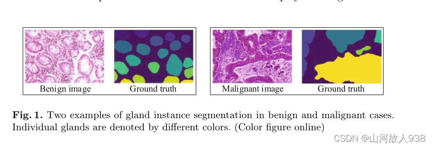 Deep Segmentation-Emendation Modelfor Gland Instance Segmentation文献学习笔记（无代码）-仅自用_chen, h., qi, x ...