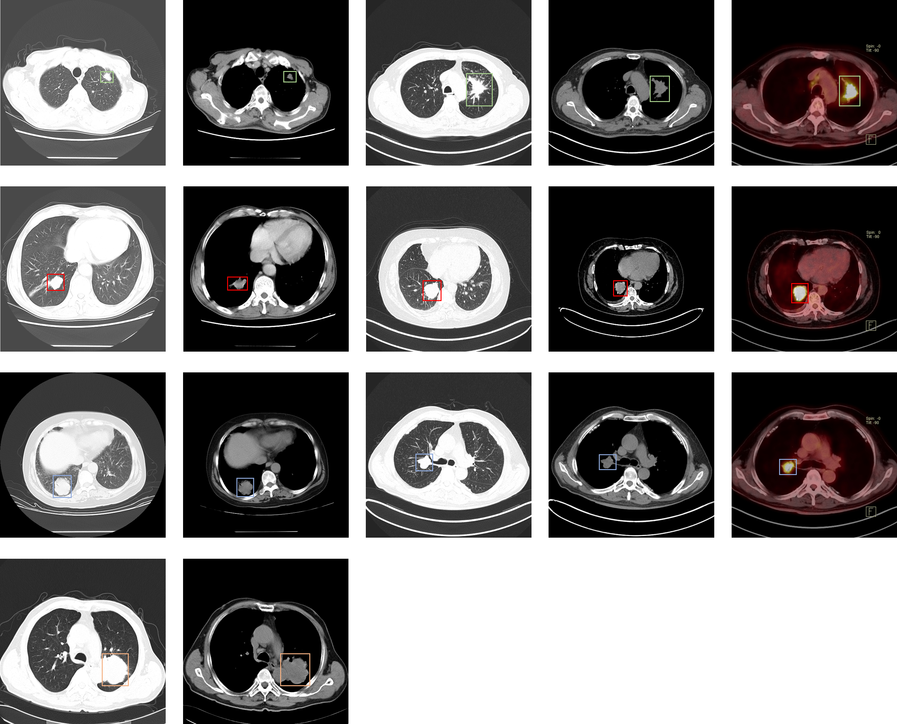 玩转肺癌目标检测数据集Lung-PET-CT-Dx ——①从TCIA获取影像数据集_tcia文件怎么打开-CSDN博客