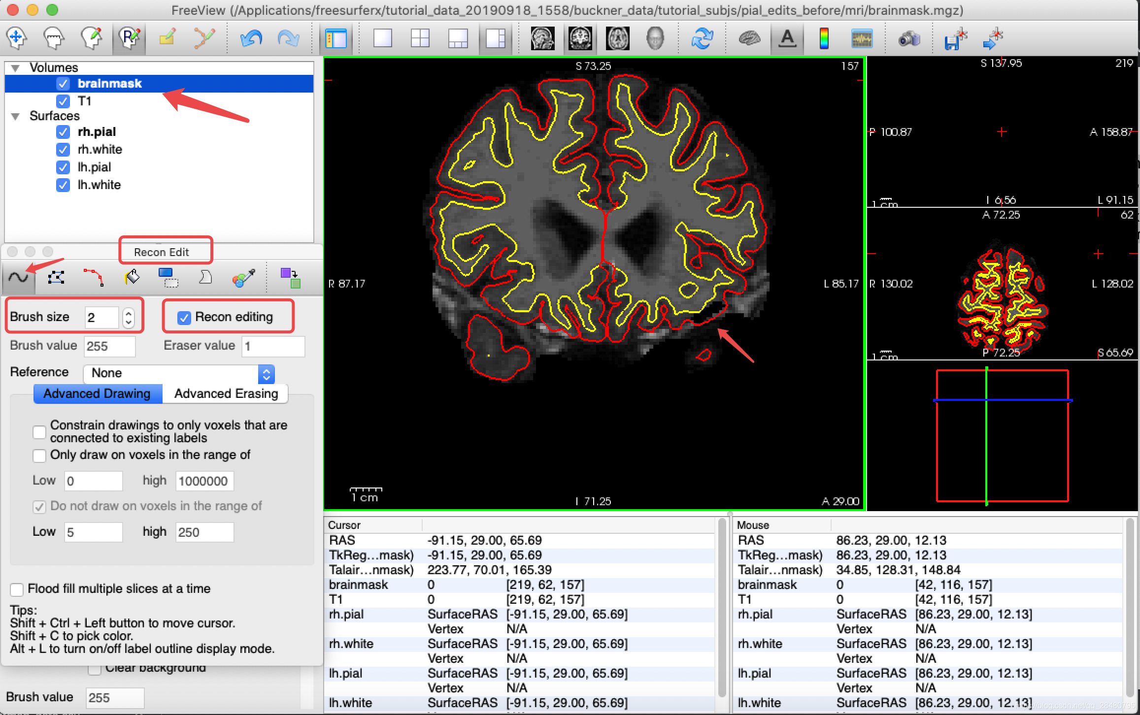 Freesurfer学习笔记——Correcting Pial Surfaces 3.1-CSDN博客