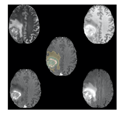 [深度学习论文笔记]Brain tumor segmentation with self-ensembled,deeply-supervised 3D U-net neural ...