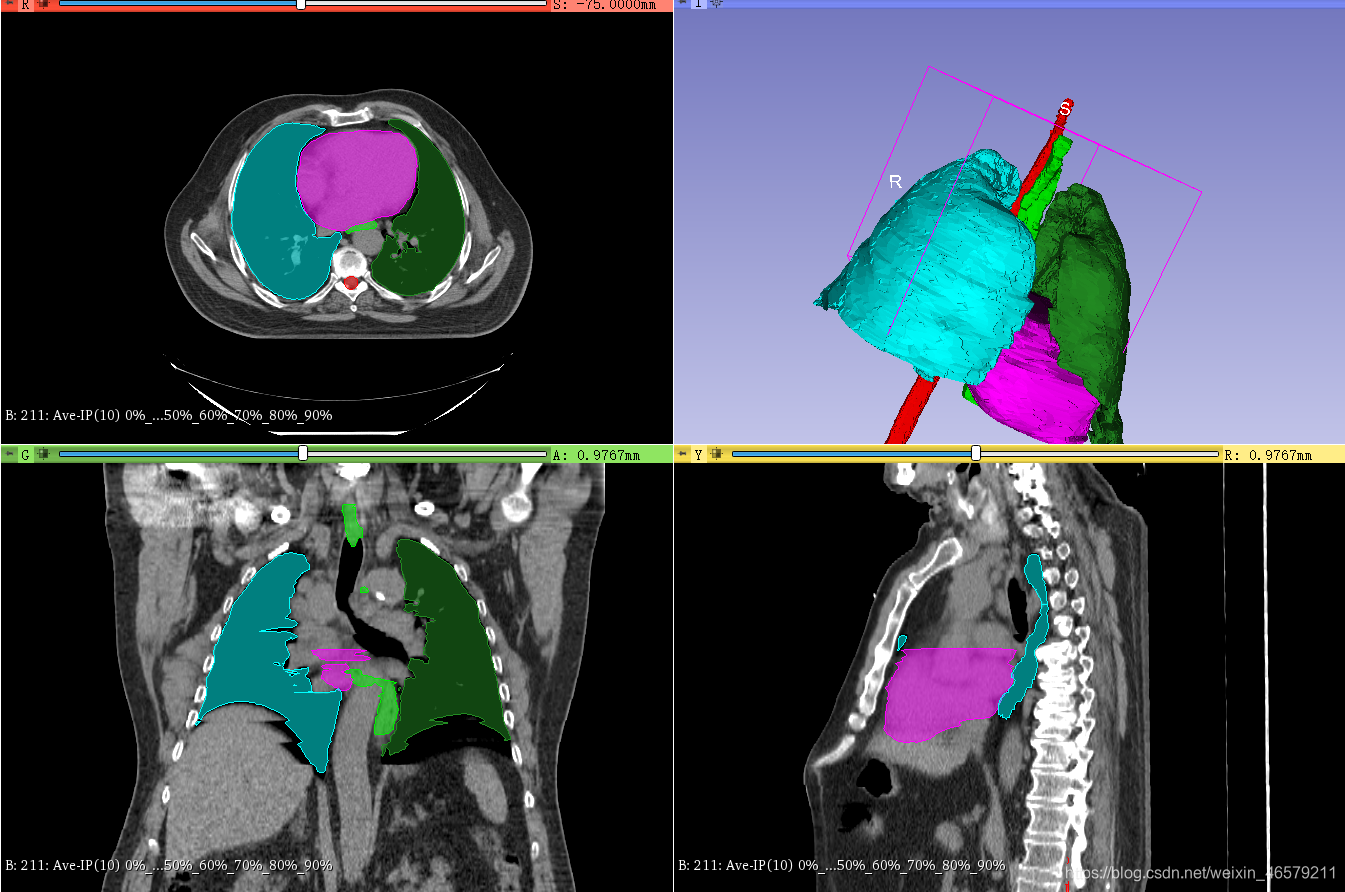 医疗图像深度学习——打开DICOM文件的RT STRUCT 标记图像并转化为图片_3dslicer rtstruct dicom export-CSDN博客