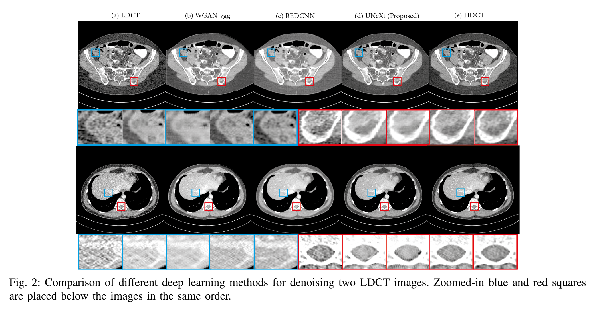 UNeXt: a Low-Dose CT denoising UNet model with the modified ConvNeXt block-CSDN博客