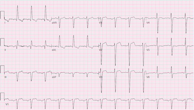 【信号处理】心电信号传统R波检测定位典型方法实现（matlab）_matlab r波标定-CSDN博客