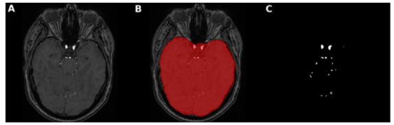 文章阅读：Generating 3D TOF-MRA volumes and segmentation labels using generative adversarial networks ...