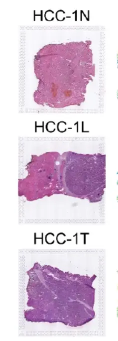 10X空间转录组数据分析之思路总结（针对肿瘤样本）_spatial gradient change analysis-CSDN博客