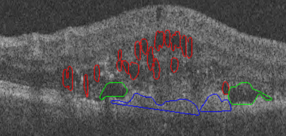 【眼底数据集】RETOUCH & REFUGE & IDRiD-CSDN博客