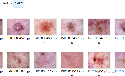 ISIC2018皮肤病分类数据集_isic2018数据集下载-CSDN博客