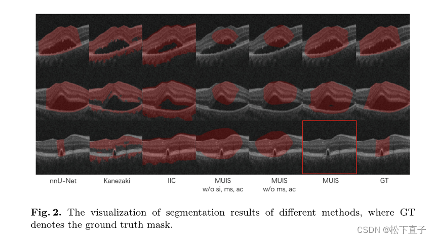 OCT图像中的多尺度无监督视网膜水肿区域分割_视网膜oct图像分割算法-CSDN博客