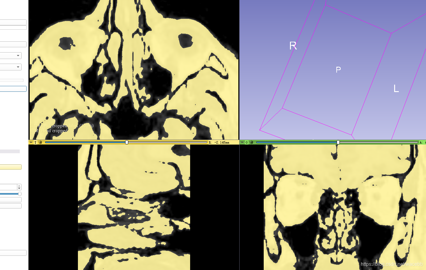 超级简单的3D slicer教程（三）creating label Map_3d slicer roi删除-CSDN博客
