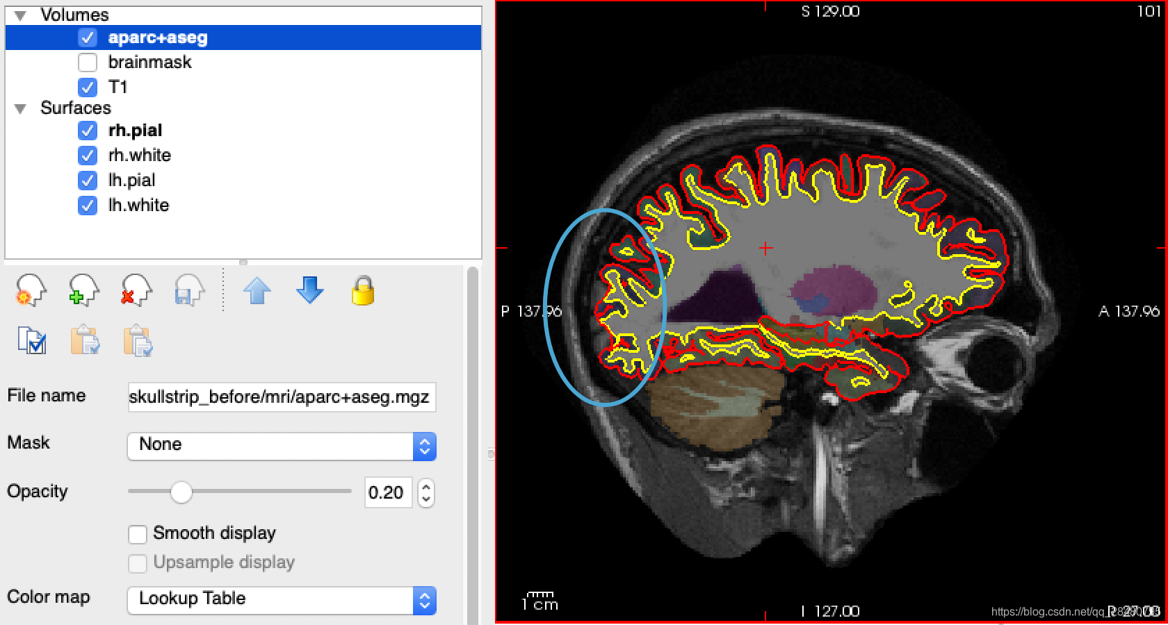 Freesurfer学习笔记——Fixing a bad skull strip3.4_freesurfer怎么看颅骨有没有剥干净-CSDN博客