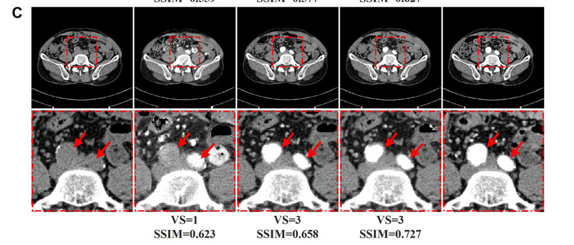 CTA-GAN：基于生成对抗性网络的主动脉和颈动脉非集中CT血管造影 CT到增强CT的合成技术-CSDN博客