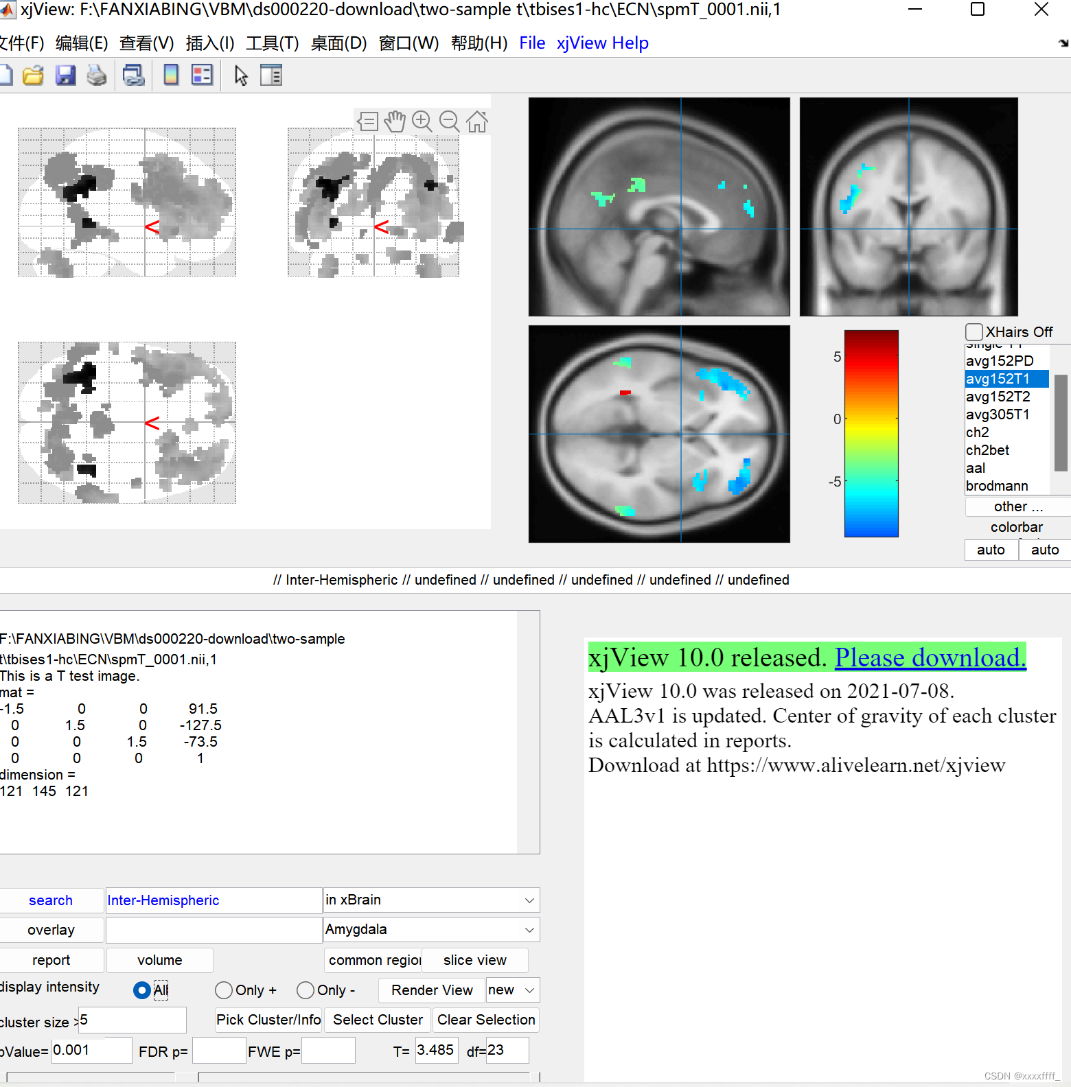 VBM后的配对t检验以及xjview使用-CSDN博客