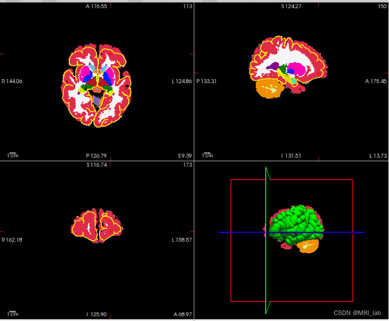 Infant-freesurfer安装和使用，适用于0-2岁婴幼儿大脑自动分割_infant freesurfer-CSDN博客