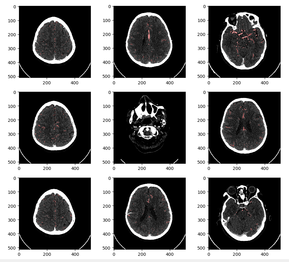 Dicom 医学图像与 nii 标签数据处理_nii数据-CSDN博客