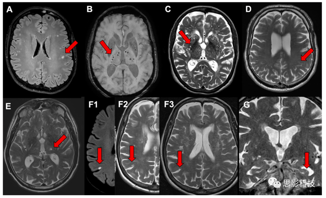 Radiology：神经影像学在痴呆症中的应用_mri 数据表明 simufilam 与淀粉样蛋白相关影像异常 (aria) 无关-CSDN博客