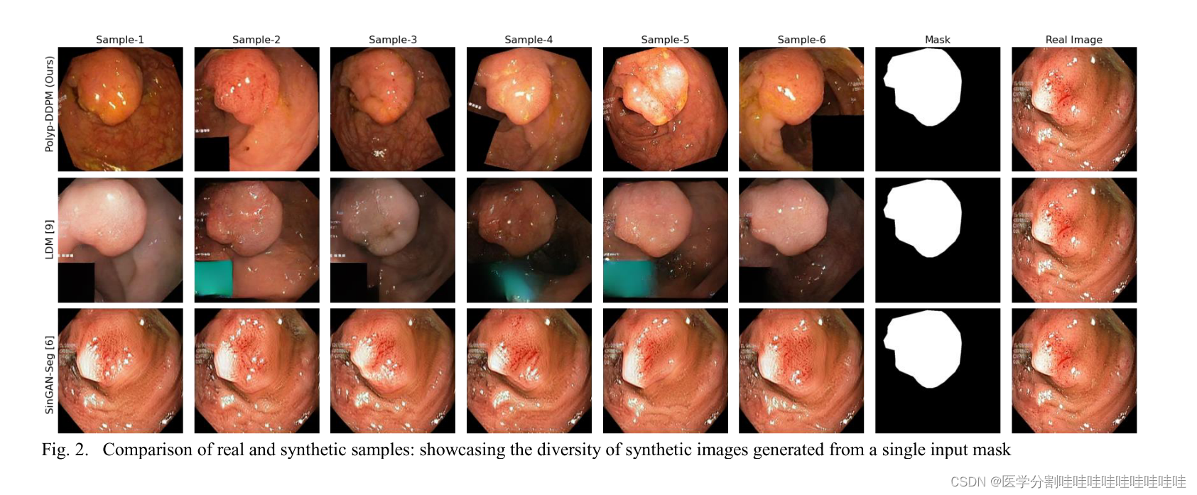 Polyp-DDPM: Diffusion-Based Semantic Polyp Synthesis for Enhanced Segmentation-CSDN博客