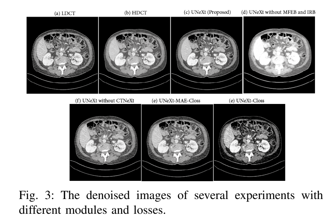 UNeXt: a Low-Dose CT denoising UNet model with the modified ConvNeXt ...
