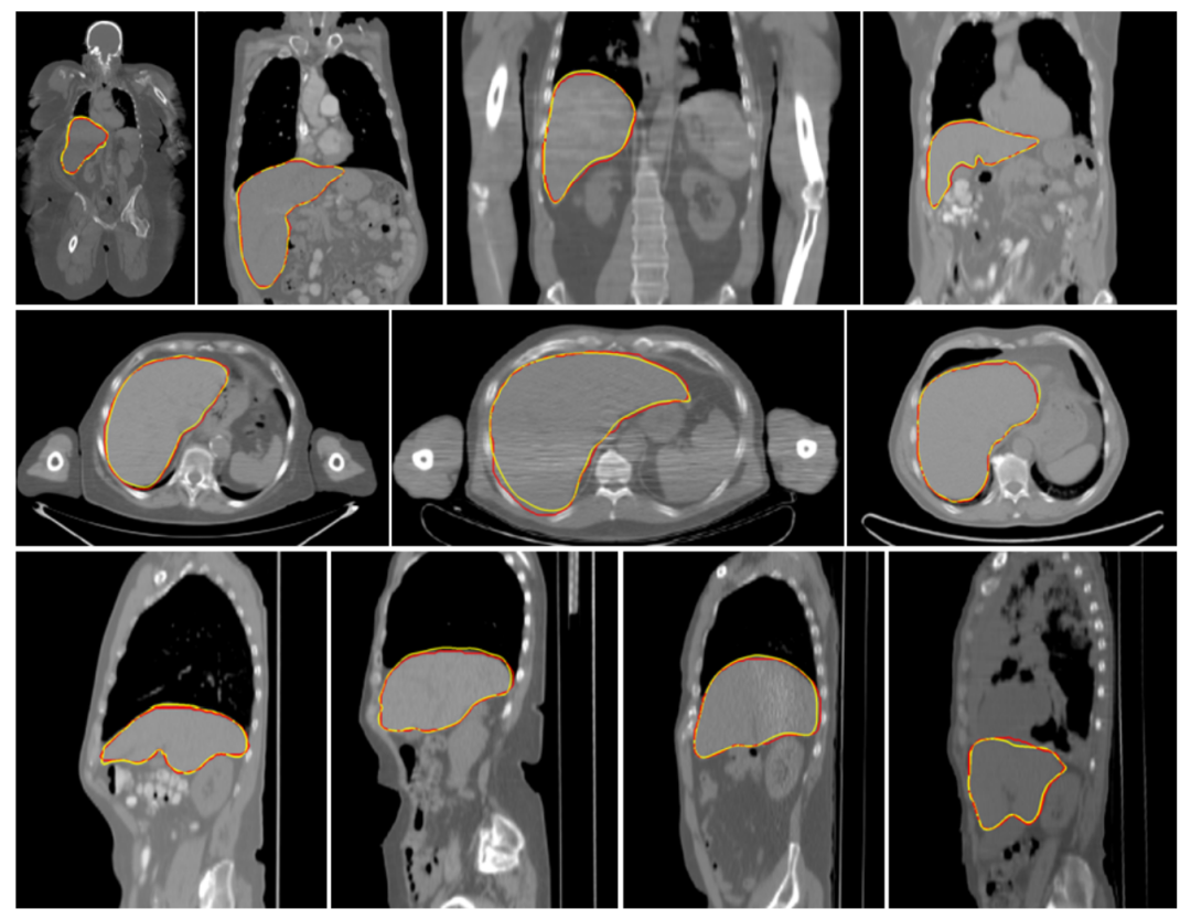 【每周CV论文推荐】GAN在医学图像分割中的典型应用-CSDN博客