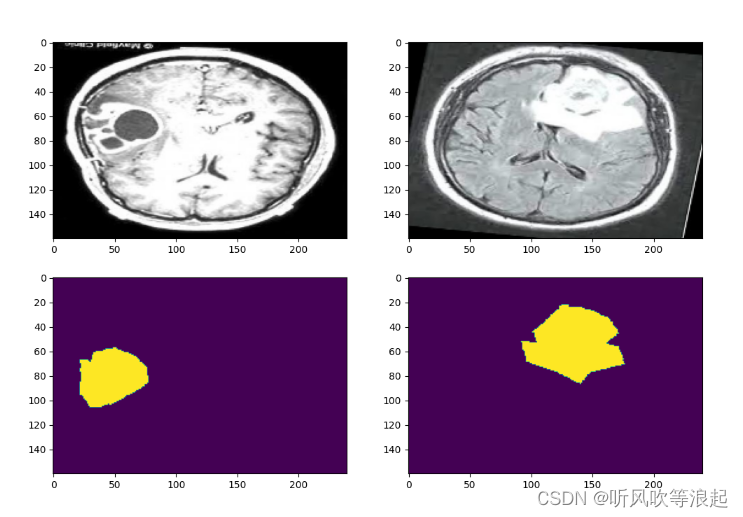 基于UnetPlusPlus(Unet++)实现的医学图像分割-CSDN博客