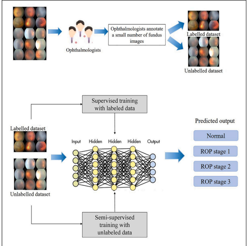 早产儿视网膜病变分期，自动化+半监督（无需大量医生标注数据）_rop眼科建模-CSDN博客