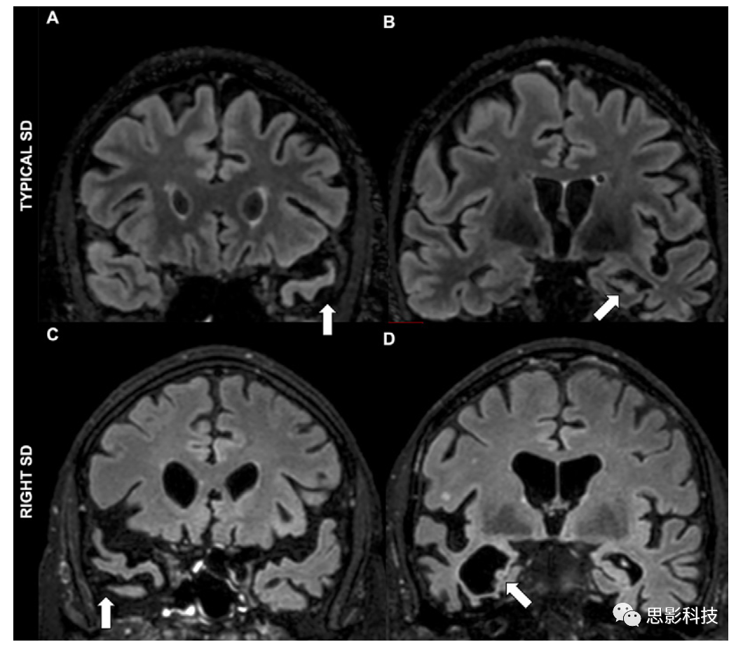 Radiology：神经影像学在痴呆症中的应用_mri 数据表明 simufilam 与淀粉样蛋白相关影像异常 (aria) 无关-CSDN博客