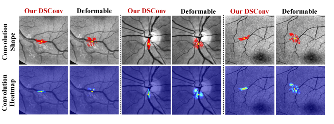 ICCV 2023 | 动态蛇形卷积（Dynamic Snake Convolution）用于管状结构分割-CSDN博客