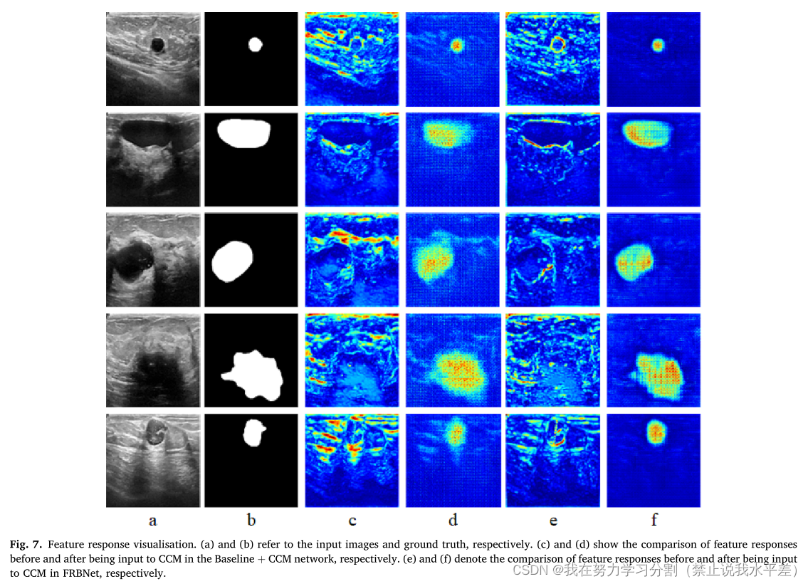 FRBNet: Feedback refinement boundary network for semantic segmentation in breast ultrasound ...