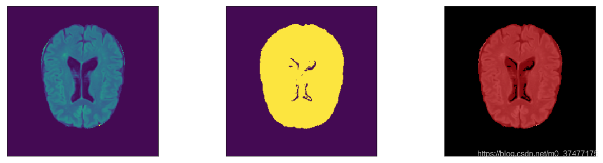 【医疗影像处理】Erosion and Dilation of medical images masks using scipy ...