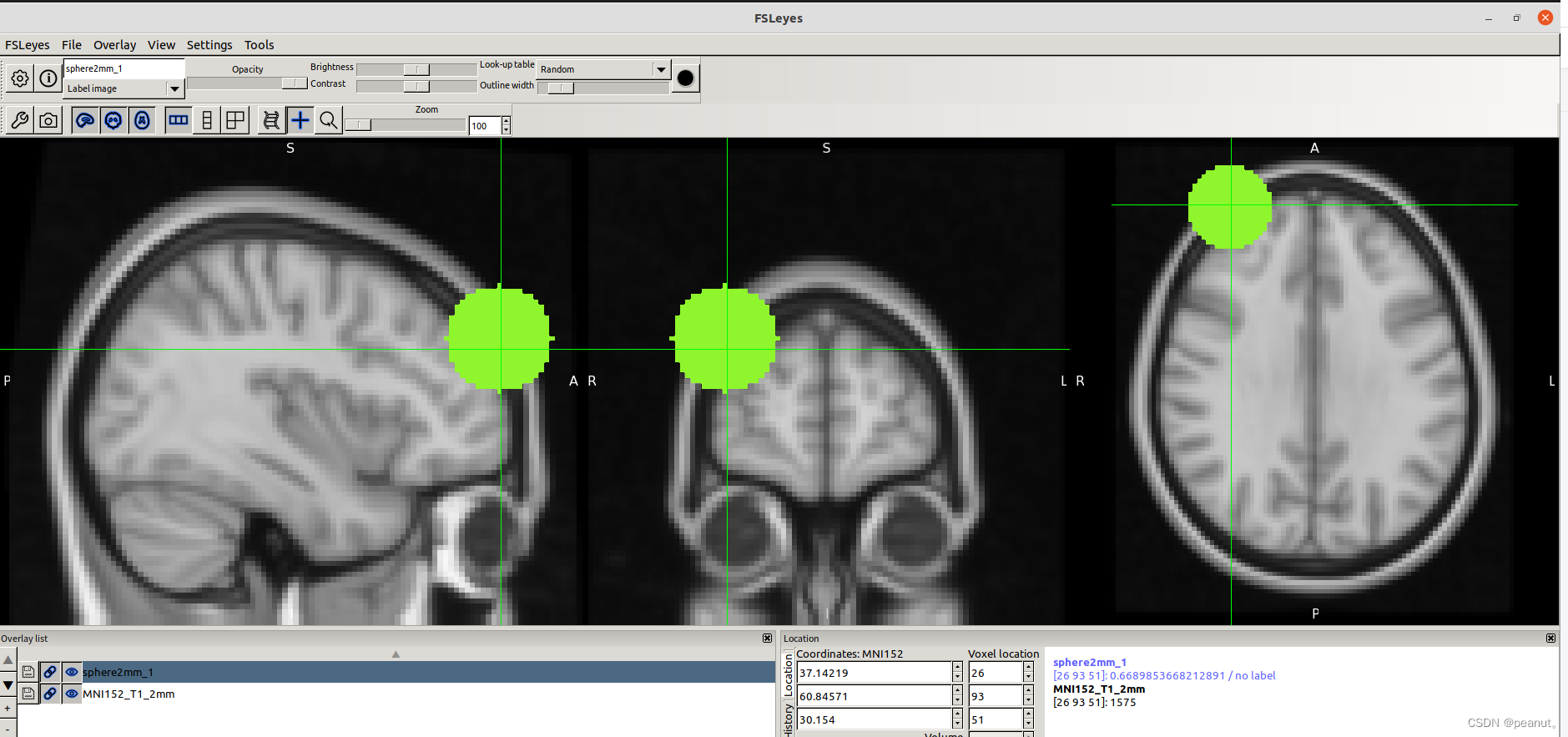 【Medical Image】MRI结构像自定义脑部ROI-基于FSL_mrview mrtrix 绘制roi-CSDN博客