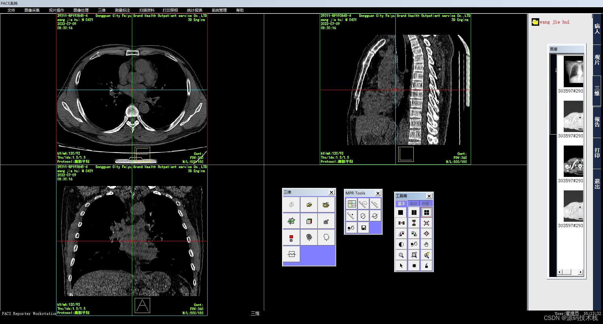 大型医院影像PACS系统三维重建技术（获取数据、预处理、配准、重建和可视化）_医学图像配准与可视化系统-CSDN博客