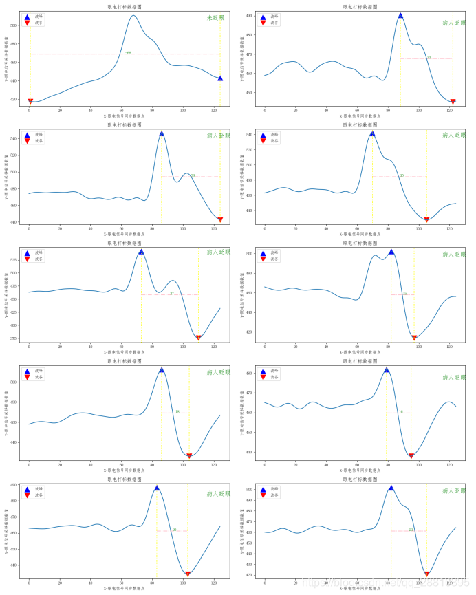 EOG眼电信号（眨眼检测）-CSDN博客