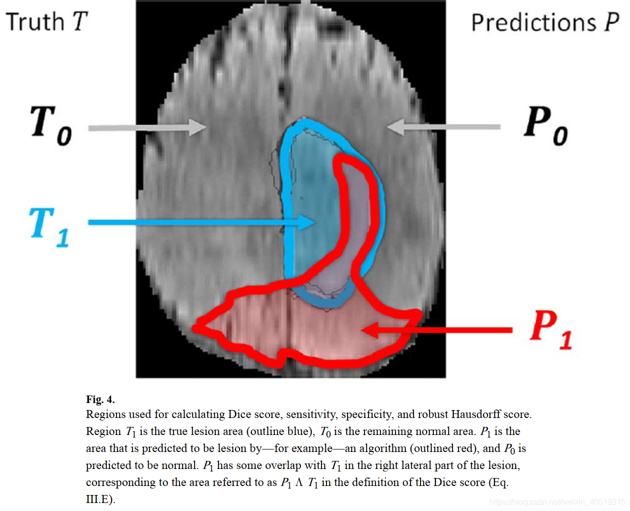 [论文解读]Brats18 NO.1:3D MRI brain tumor segmentation using autoencoder ...