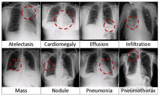 Medical X-rays Dataset汇总（长期更新）_vindr-cxr-CSDN博客