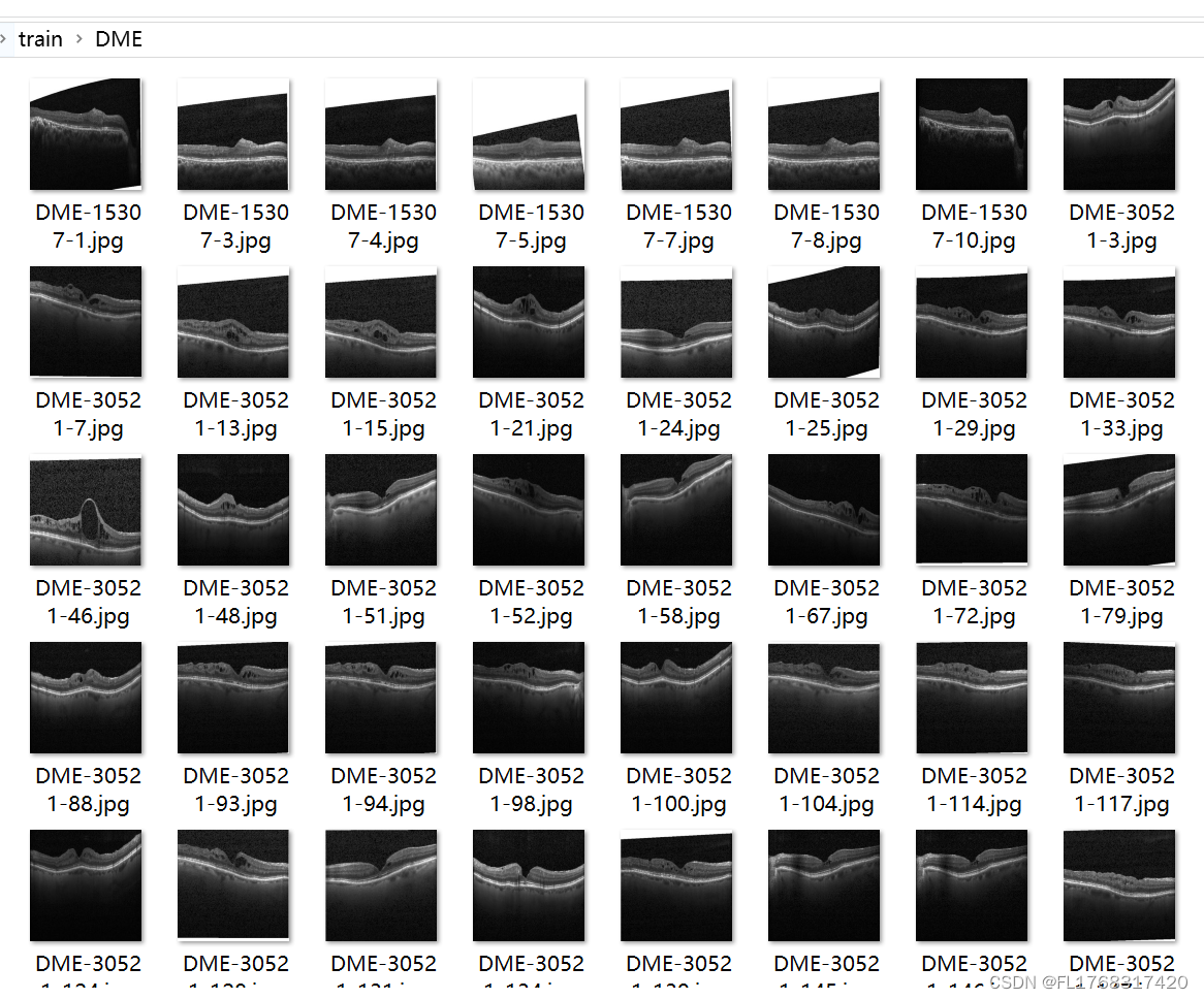 医学OCT视网膜疾病识别分类数据集14600张4类别_oct数据集-CSDN博客