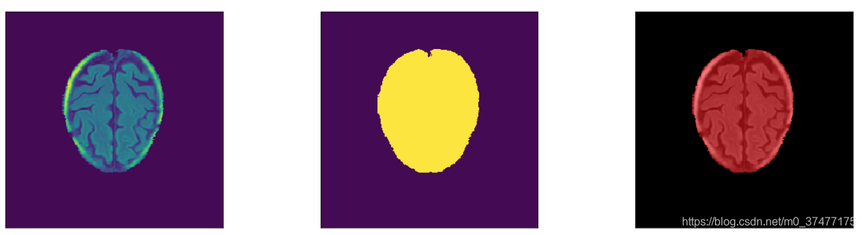 【医疗影像处理】Erosion and Dilation of medical images masks using scipy ...