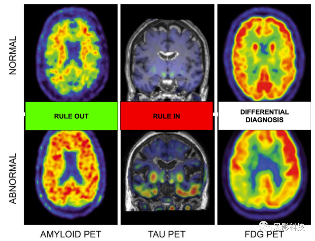 Radiology：神经影像学在痴呆症中的应用_mri 数据表明 simufilam 与淀粉样蛋白相关影像异常 (aria) 无关-CSDN博客