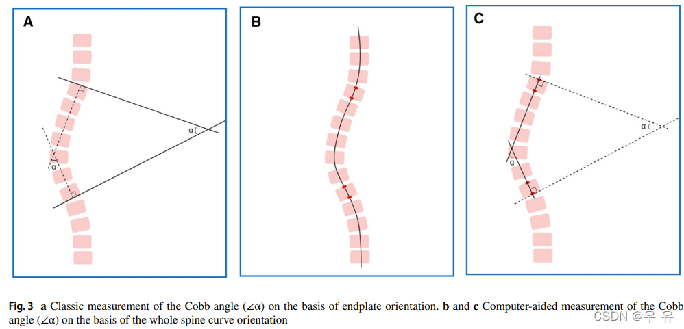 【翻译】Evaluation of a computer‑aided method for measuring the Cobb angle ...