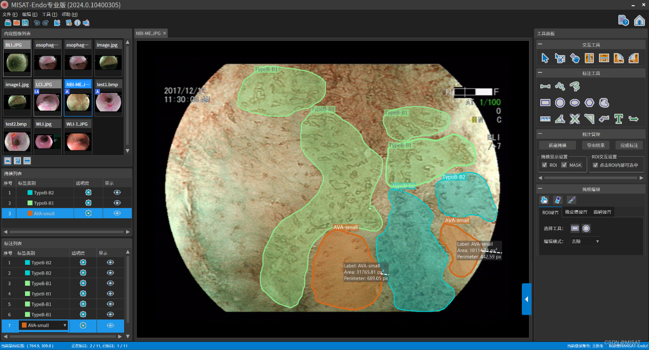 MISAT医学图像分割与标注软件套装专业版正式上线-CSDN博客