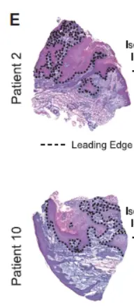 10X空间转录组数据分析之思路总结（针对肿瘤样本）_spatial gradient change analysis-CSDN博客