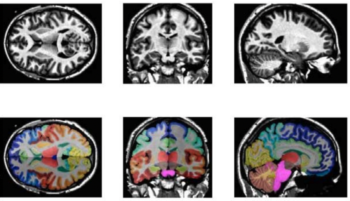 使用 Monai Bundle 和 Model Zoo 对医学影像数据进行分类-全脑133个结构分割-CSDN博客