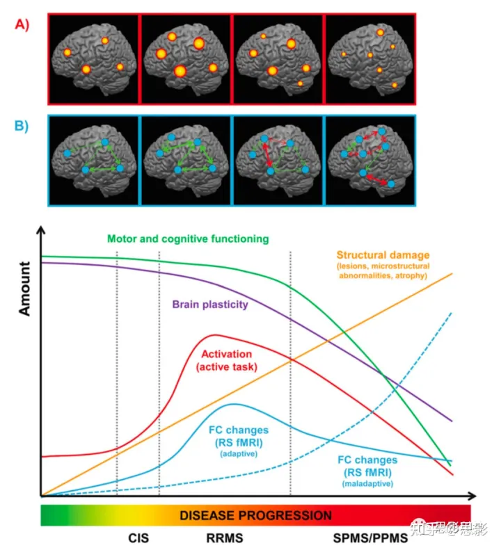 MS中的功能MRI：揭示大脑可塑性与病理生理学-CSDN博客