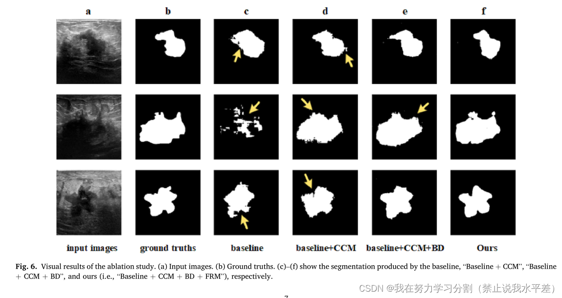 FRBNet: Feedback refinement boundary network for semantic segmentation in breast ultrasound ...