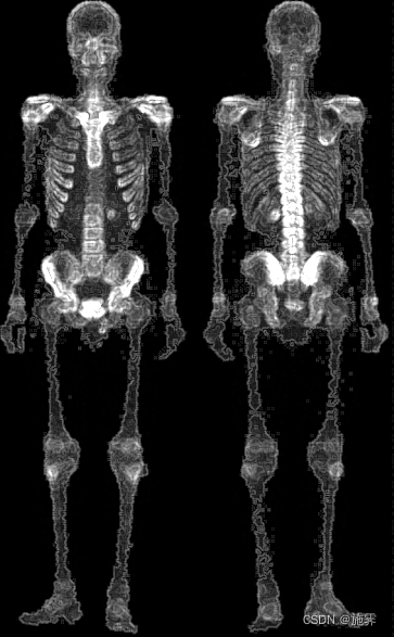 数字图像处理上机实验之医学骨骼增强（OpenCv+Python）_人体骨骼图像增强-CSDN博客