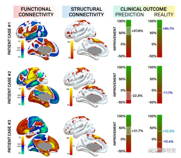 连通性可预测深部脑刺激（DBS）对帕金森的疗效_ppmi数据库-CSDN博客