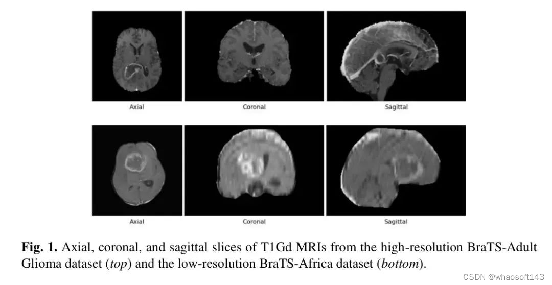 Bridging the Gap_brats2023-ssa数据集-CSDN博客