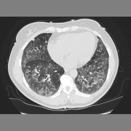 通过python-CNN训练识别CT患病-含数据集+pyqt界面_pytorch判断患病-CSDN博客