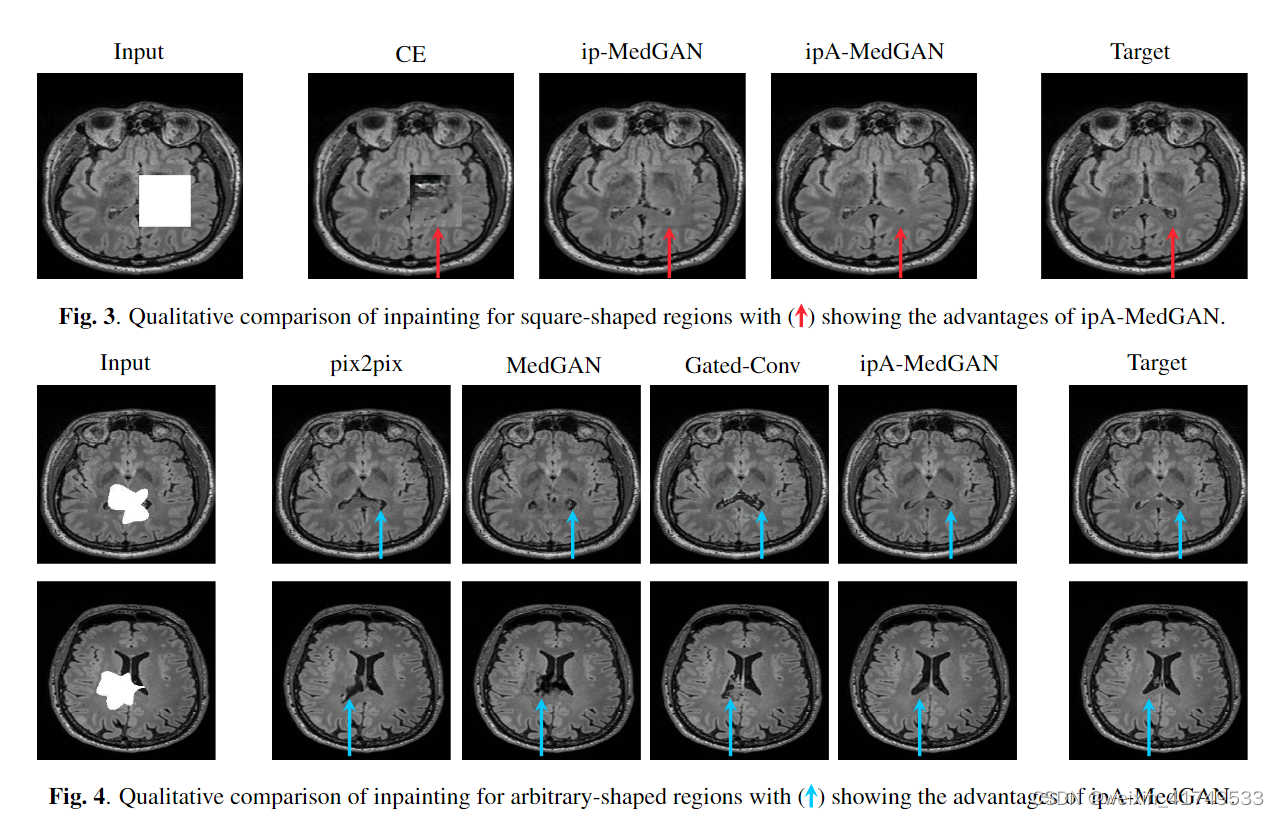 ipA-MedGAN: INPAINTING OF ARBITRARILY REGIONS IN MEDICAL MODALITIES ...