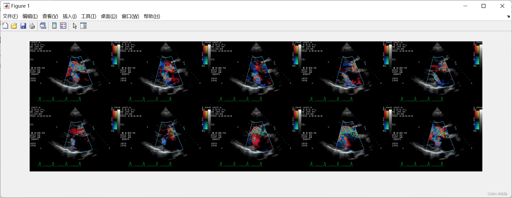 Matlab之dicom(数字图像和通信医学)格式图像数据读取函数dicomreadmatlab Dicom Csdn博客